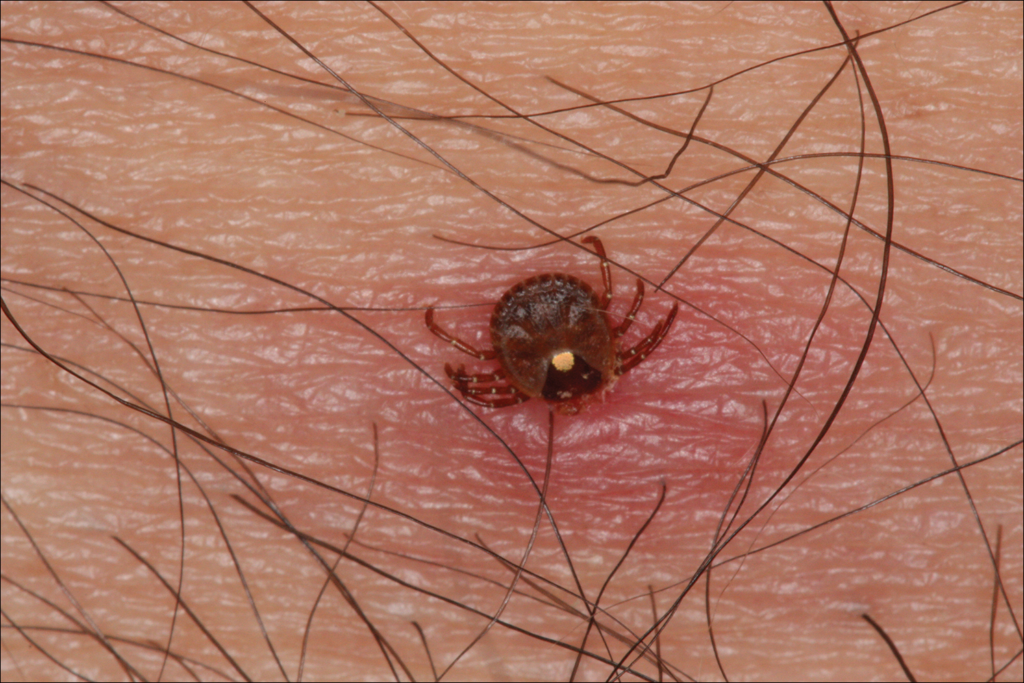 Insect Bites (5 Kinds!) and Poison Ivy - Sharing Horizons